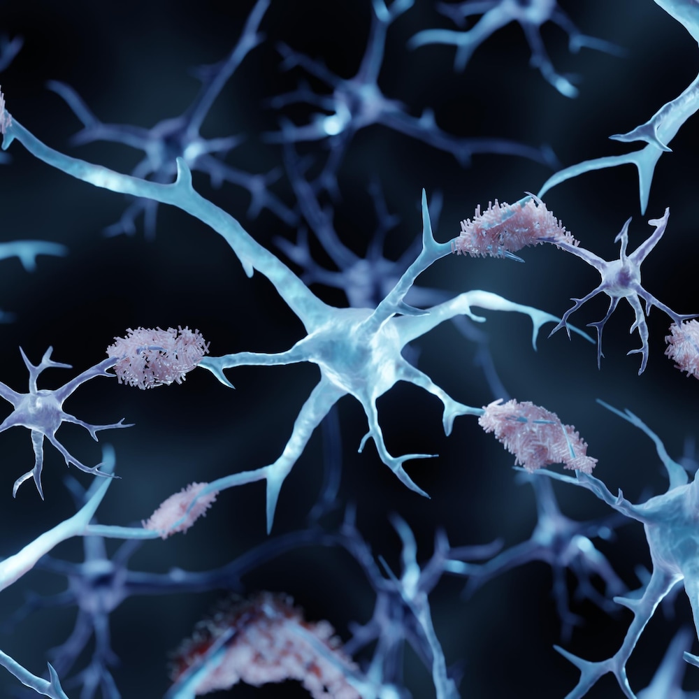 Alzheimer : où en sommes-nous? | Radio-Canada.ca