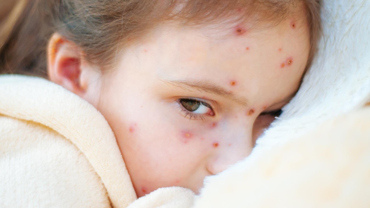 Nouveau cas de rougeole à Vancouver | Radio-Canada.ca