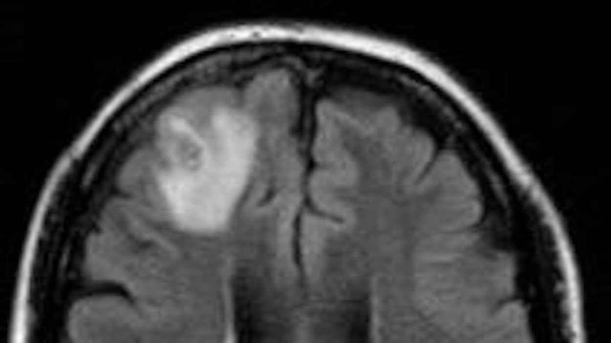 Un ver qui parasite les serpents découvert dans le cerveau d’une ...