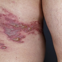 Tout savoir sur le zona, ses complications et l’importance du vaccin ...