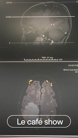 Freiner la propagation mortelle d’une tumeur cérébrale agressive | En ...