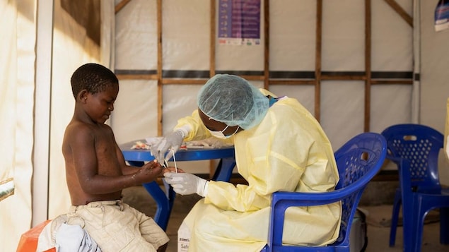 Mpox Is A Global Emergency Again How Deadly Is It What Are Clades What You Need To Know