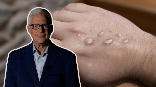 Charles Tisseyre démystifie le virus mpox | Radio-Canada