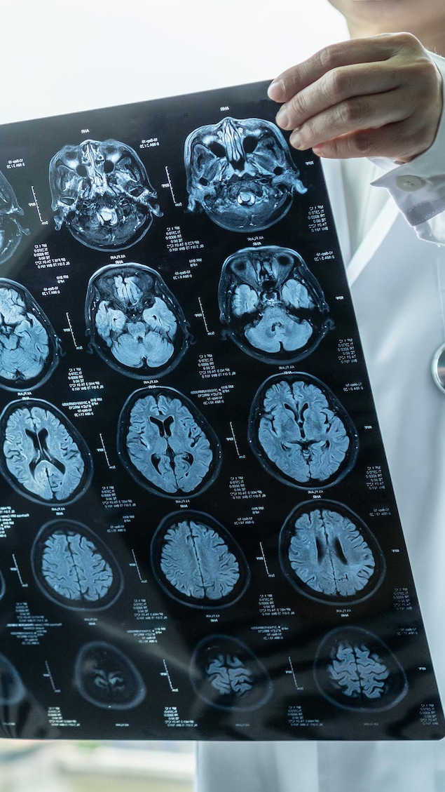 Un nouveau test pour prédire les symptômes de l’alzheimer | En bref ...