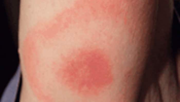 Quand la maladie de Lyme s’attaque au cœur | Radio-Canada