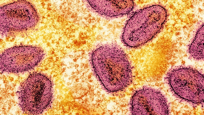 Le Québec n’est pas prêt à dépister le clade 1b du virus mpox | Radio ...