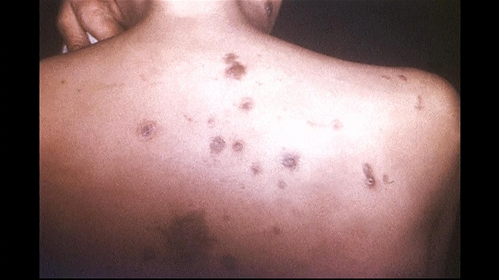 Les cas de syphilis deux fois plus élevés dans la Capitale-Nationale qu ...