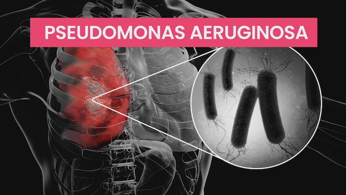 Sa bouteille de Pine-Sol l’a-t-elle rendue malade? | Radio-Canada