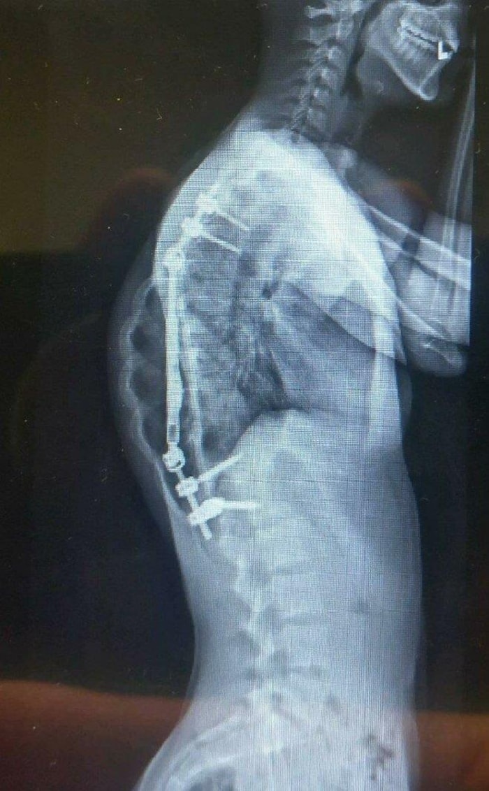 Nouveau traitement de la scoliose au Centre de soins de santé IWK d ...