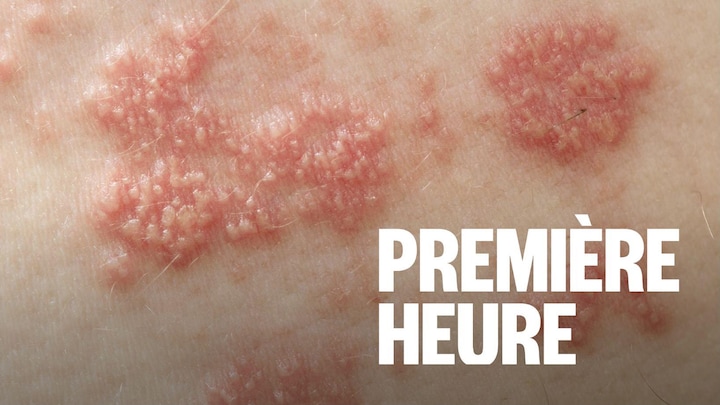 Doit-on s’inquiéter du zona chez les plus jeunes? | OHdio | Radio-Canada