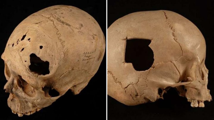 La trépanation dans la préhistoire