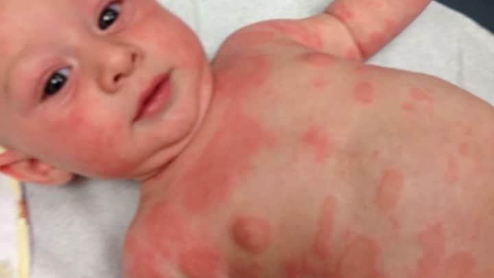 Allergies et maladies de la peau, le sort du petit James | OHdio ...