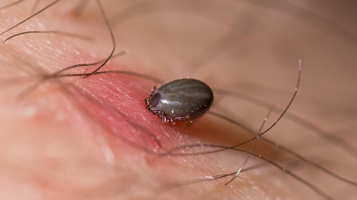 Comment réagir à une morsure de tique? | OHdio | Radio-Canada