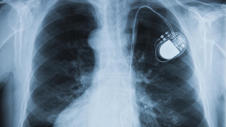 Les stimulateurs et défibrillateurs cardiaques, des appareils ...