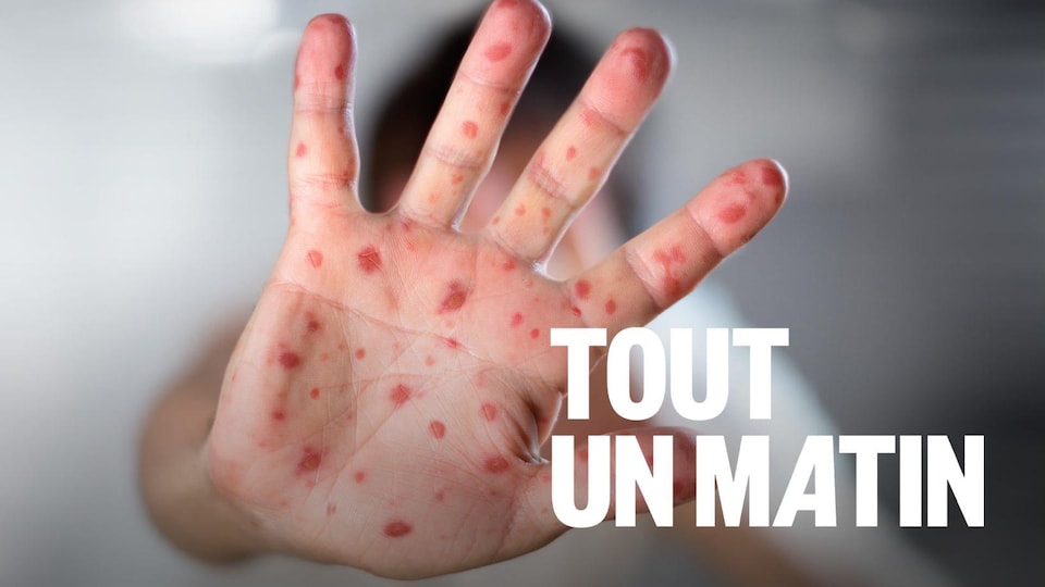 Comment expliquer le retour en force de la rougeole au Canada?