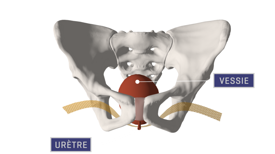 Retrait de bandelettes urinaires : des patientes se sentent abandonnées ...