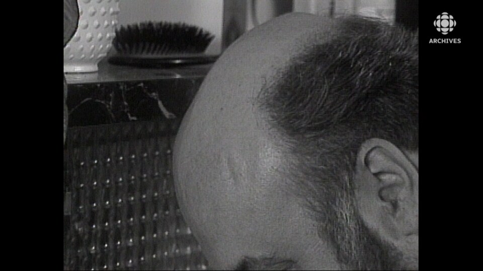 La calvitie, une préoccupation masculine qui n’a pas perdu un poil ...