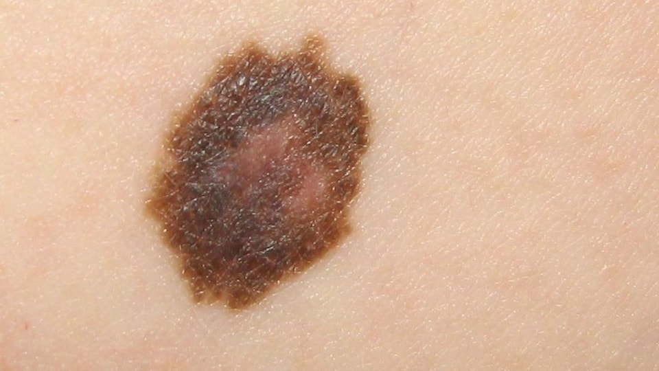 Cancer de la peau : le mélanome en hausse au Canada