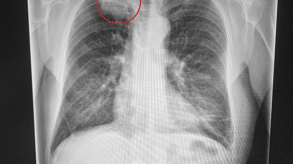 Un homme atteint de cancer poursuit son médecin pour retard de ...