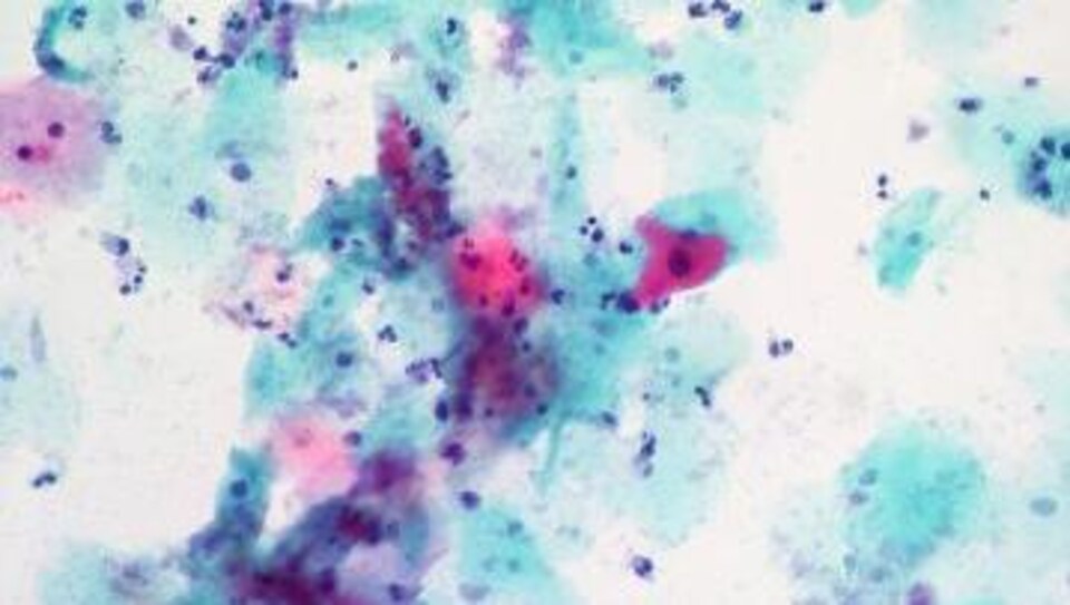Le test du VPH plus efficace pour détecter le cancer du col de l'utérus ...