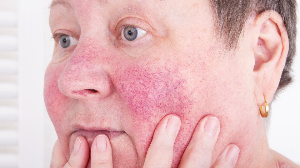 5 conseils pour lutter contre la rosacée