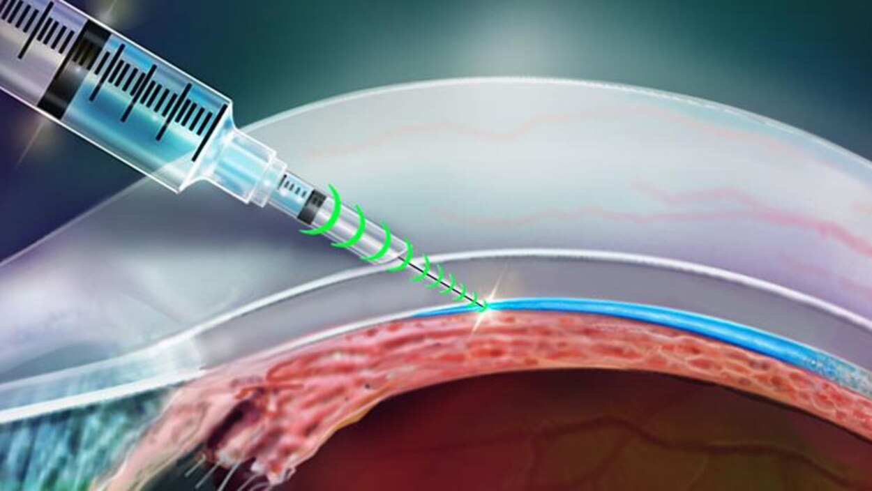 Une aiguille intelligente créée | Radio-Canada