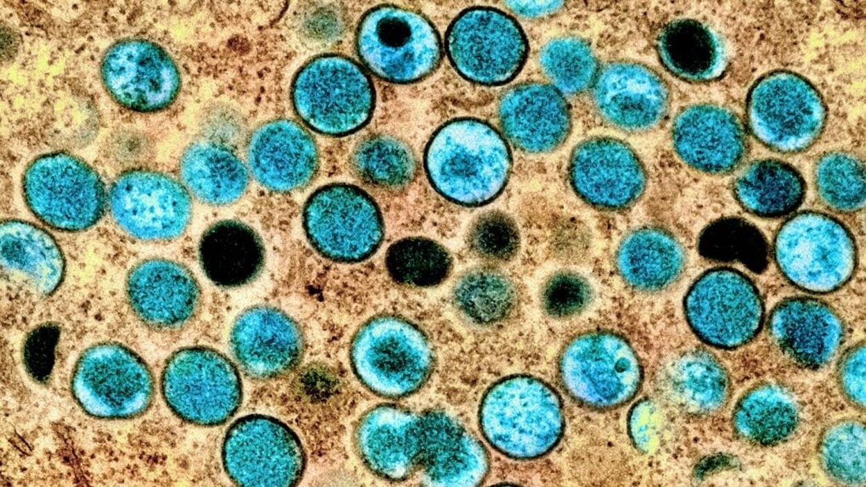 [Ulat] Unang kaso ng monkeypox sa Pilipinas kinumpirma ng DOH | Radio ...