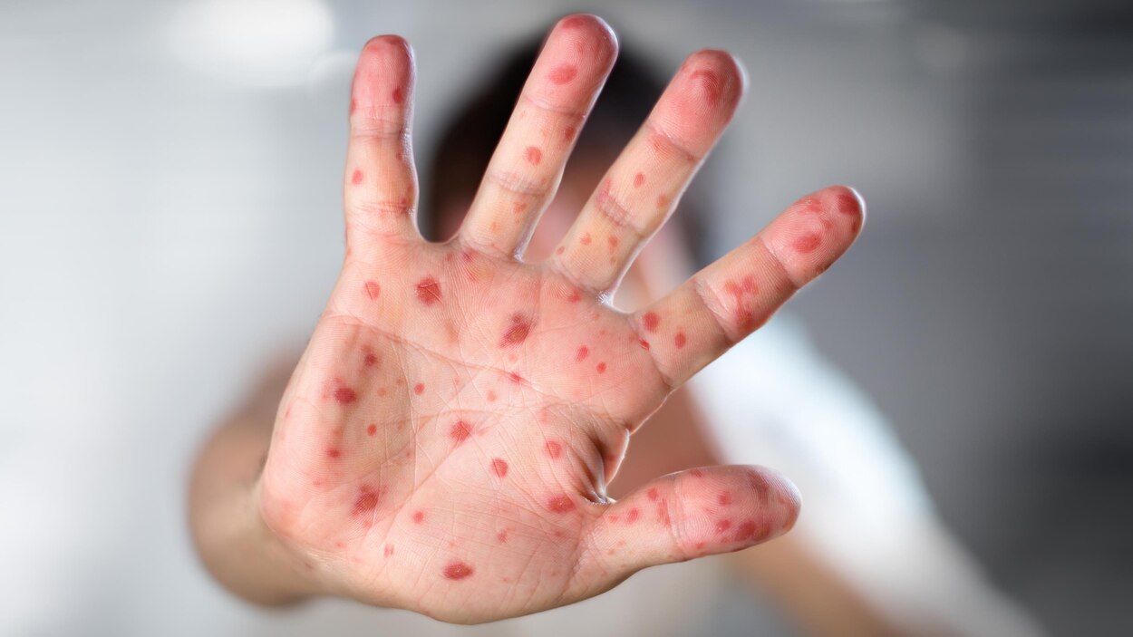 Risque de transmission de la rougeole à Banff | Radio-Canada