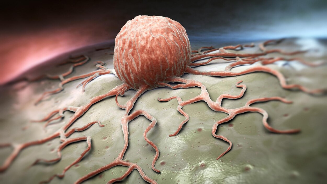 Détecter le cancer avant la formation d’une tumeur | Radio-Canada
